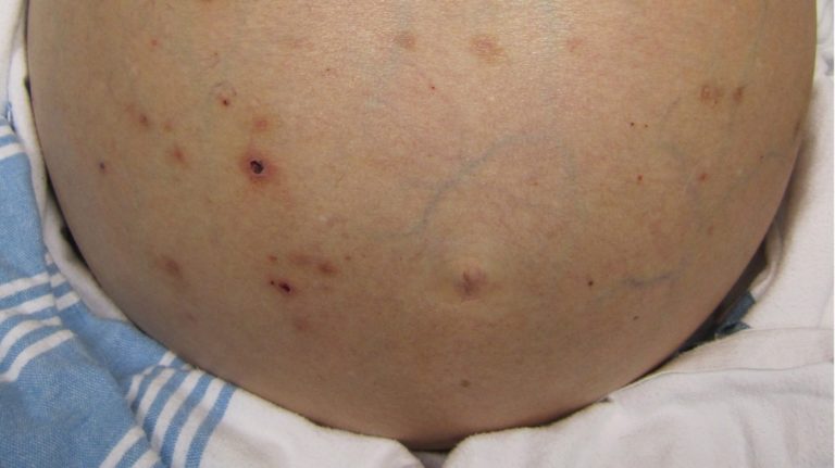 Ittero: cause e sintomi con immagini - Laboratorio Dr. D'Errico Angelo